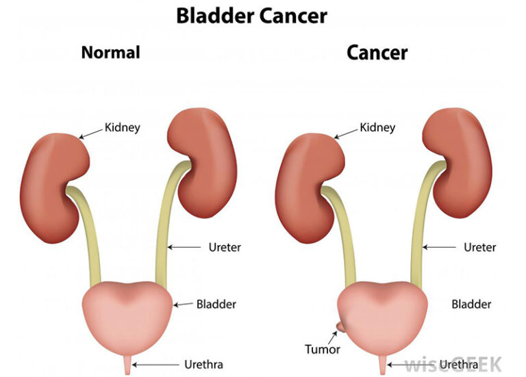 An Overview Of Transurethral Resection Of The Bladder