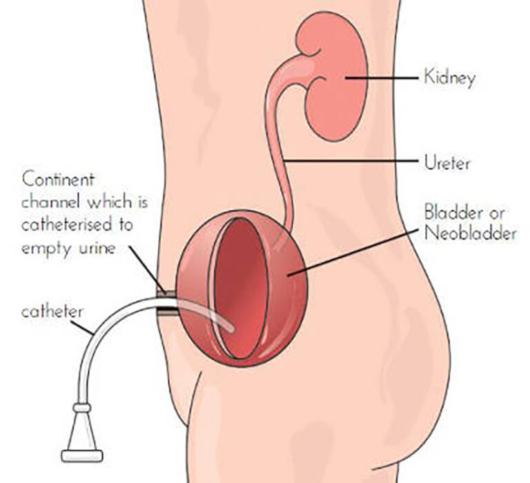 What Is Cystectomy Urology Specialist