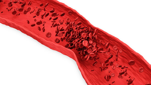 An Overview of Thrombectomy