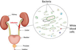 An Overview of Urinary Tract Infection (UTI) | Urology Specialist