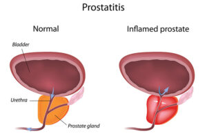 Prostatitis and what you need to know